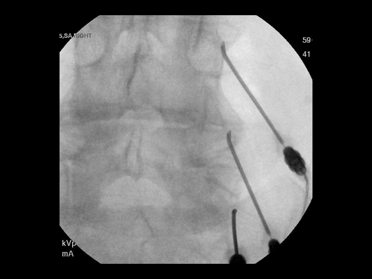 Radiofrequency Ablation – Pain Treatment Center Anesthesiologists