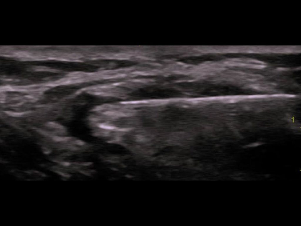 Diagnostic Peripheral Nerve Blocks – Pain Treatment Center ...