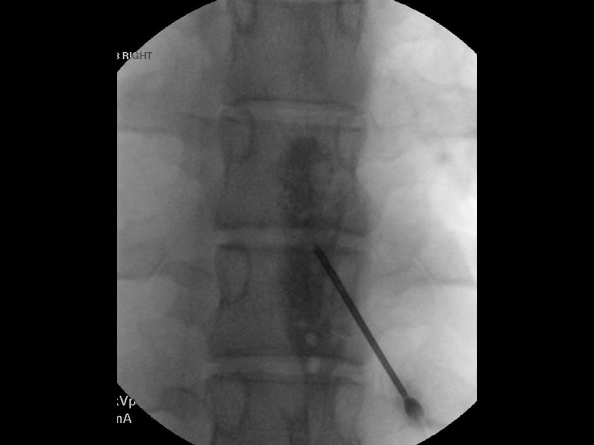 Epidural Steroid Injections – Pain Treatment Center Anesthesiologists